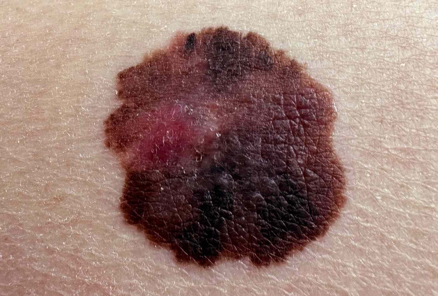 Czerniak: Wczesne wykrywanie, leczenie i profilaktyka