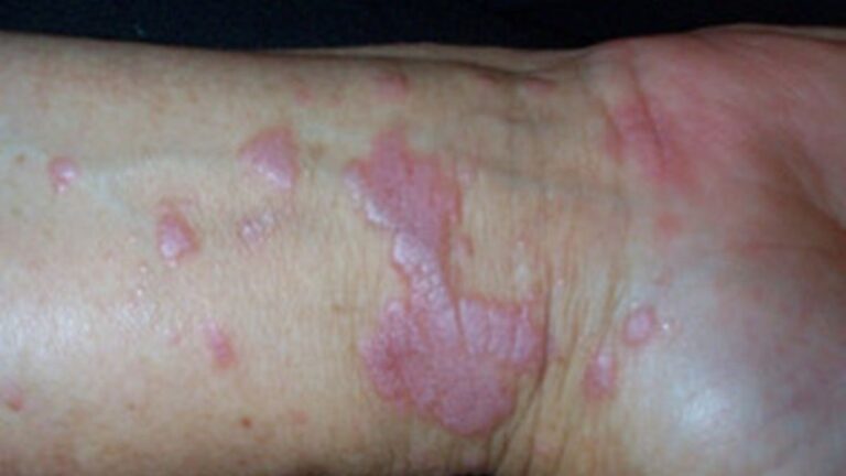 Liszaj: Objawy, Leczenie i Wpływ na Codzienne Życie