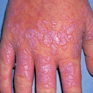 Liszaj: Objawy, Leczenie i Wpływ na Codzienne Życie