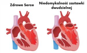 Niedomykalność zastawki dwudzielnej: Wyzwania i Nadzieje