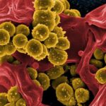 Posocznica: Definicja, Objawy i Metody Leczenia